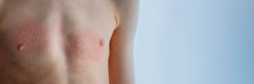 What Causes Eczema? - Access Total Care